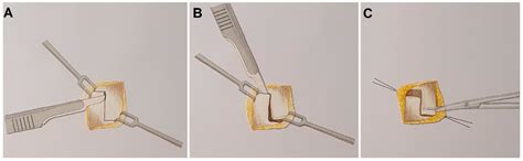 Reconstruction Of Chronic Soft Tissue Mallet Fingers Outcomes Of Step Plasty Vs Purse String