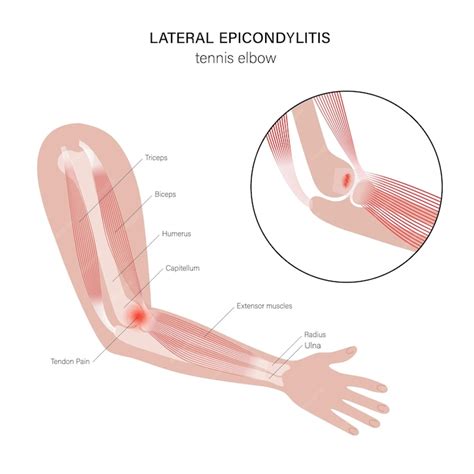 Codo De Tenista Con Epicondilitis Lateral Vector Premium