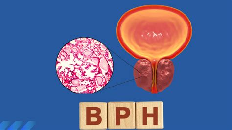 Benign Prostatic Hyperplasia Bph An Increasingly Common Male