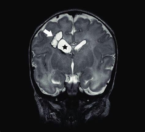 Postnatal Brain Magnetic Resonance Imaging Cystic Encephalomalacia Download Scientific Diagram