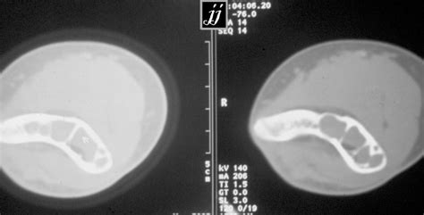 Msk Distal Humerus Lytic Lesion Radioogle
