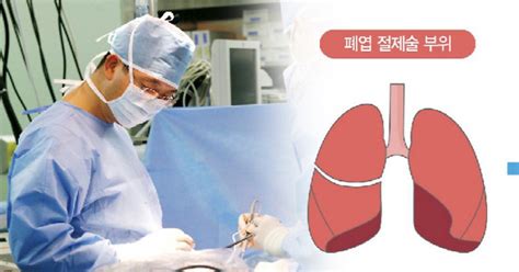폐암 조기 발견하면 작은 구역만 잘라도 폐 기능 생존율 향상