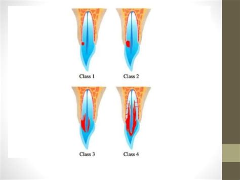Root Resorption