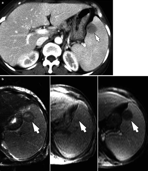Malignant Focal Lesions Of The Spleen Radiology Key