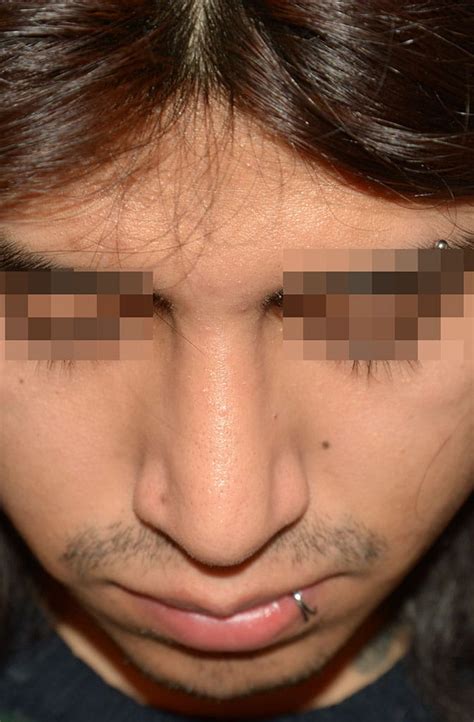 Male Rhinoplasty 25 Robert A Guida Md Pc