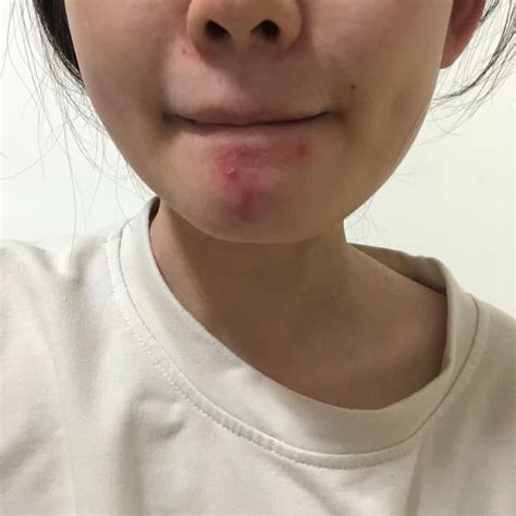 詢問 請益下巴囊腫痘醫美 醫美板 Dcard