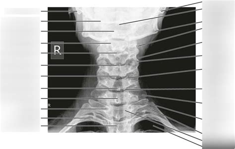 C Spine Ap Label Diagram Quizlet