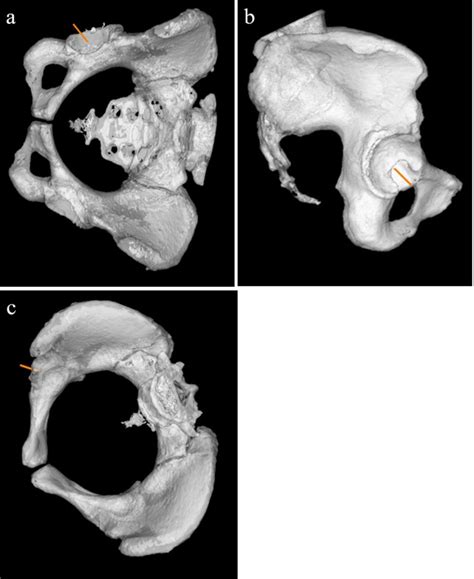 Intraoperative Pelvic Motion In The Lateral Decubitus Position