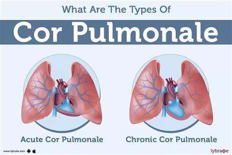 Cor Pulmonale Causes Symptoms Treatment And Cost