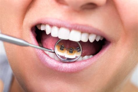 Lingual Orthodontics Materials And Clinical Procedures