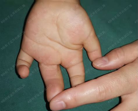 并指免植皮案例2男孩复杂并指妈妈多年坚守终四指变五指 哔哩哔哩
