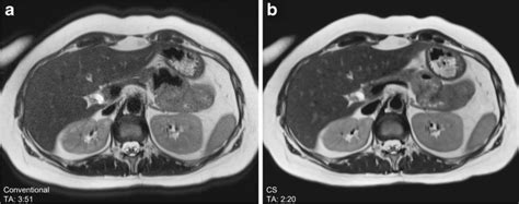 Compressed Sensing Reduced Acquisition Time Without Image Degradation