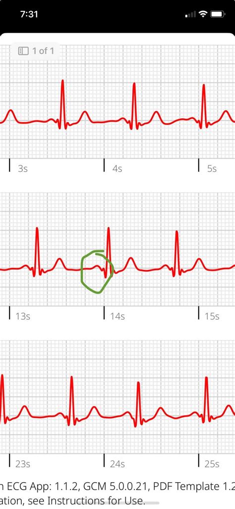 Is This A Double P Wave Notched Or Biphasic R Readmyecg