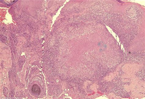 Global Skin Path Atlas Diagnosis Detail
