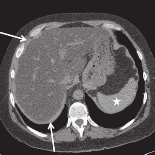 Hepatic Steatosis On Non Contrast Chest CT A Axial Upper Abdominal Download Scientific