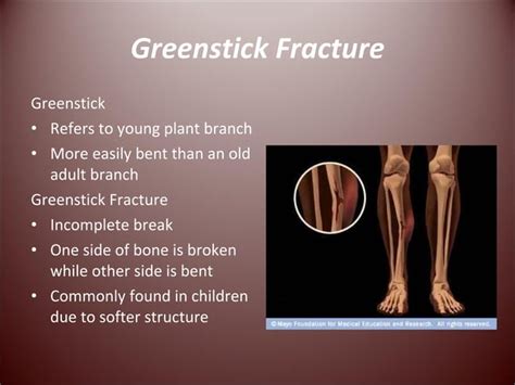 Transverse Fracture Presentation Bio 120 Ppt
