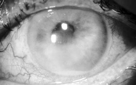 Hypopyon In Patient With Uveitis Taking Rifabutin And Clarithromycin
