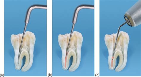Continuous Wave Compaction Technique Using Elements™ Obturation Unit A Download Scientific