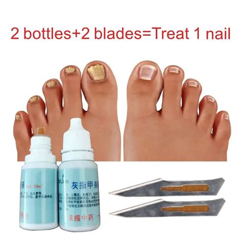 Nail Podiatry Ingrown Toenail Onychomycosis Antifungal For Nail Fungus