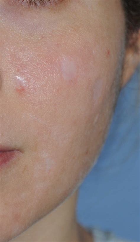 Acne Scar Treatment Before After Photos Seattle Bellevue