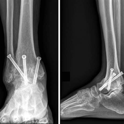 Pdf Arthroscopic Ankle Arthrodesis