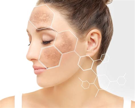 Chemical Peels Benfleet Aesthetics In Benfleet Essex