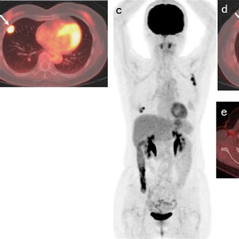 A 66 Year Old Man With Postoperative Recurrence Malignant Melanoma With