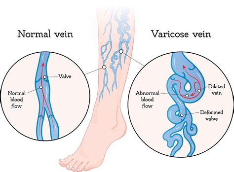 Varicose Veins Evansville Regional Vein Center