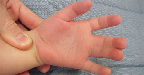 Conditions Associated With Webbed Hands And Feet