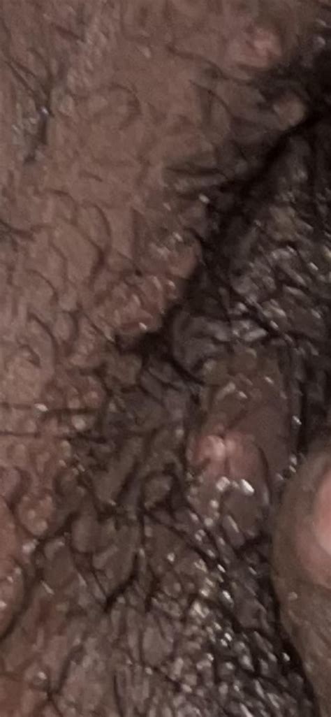 Are These Folliculitis R Folliculitis