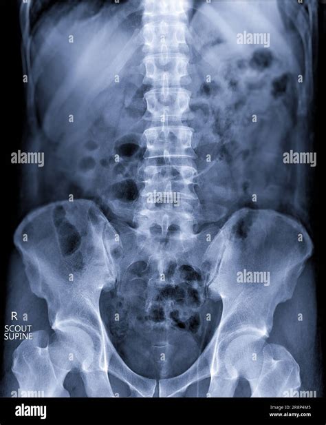 Intravenous Pyelogram Or I V P Is An X Ray Exam Of Urinary Tract After Injection Contrast Media