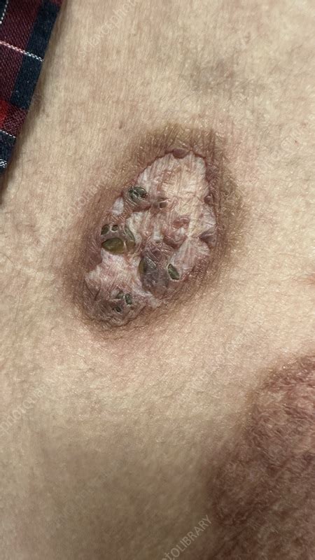 Pyoderma Gangrenosum Treated With Infliximab Stock Image C059 9149 Science Photo Library