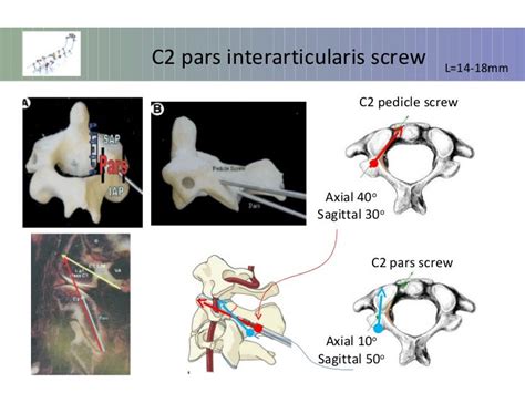 Cervicalscrew2011