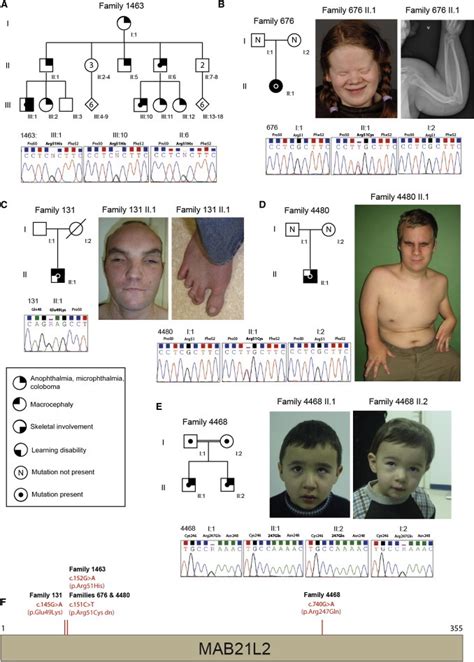 Monoallelic And Biallelic Mutations In Mab21l2 Cause A Spectrum Of