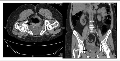 Figure 2 From Beware The Stone In The Duplex Use Of Ct Intravenous