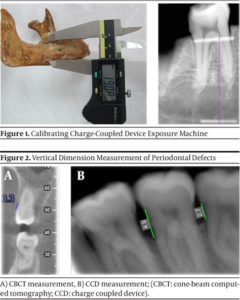 Figure 1 From Comparison The Accuracy Of The Cone Beam Computed Tomography With Digital Direct