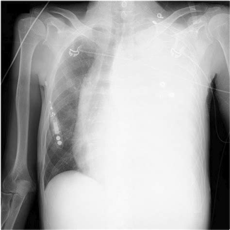 Chest X‐ray Showed A Left‐sided Massive Pleural Effusion With A