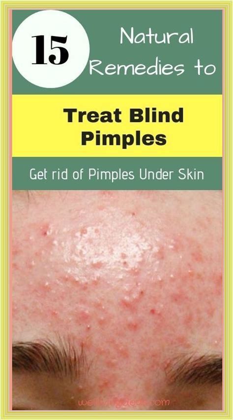 How To Get Rid Of Pimples Overnight Brown Spots On Face Blind Pimple