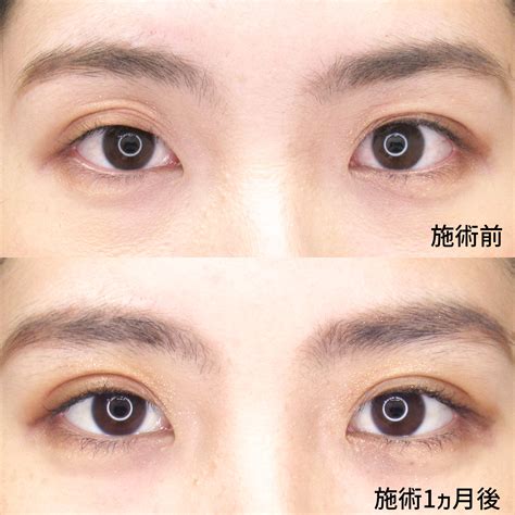 埋没法で左右差改善｜症例写真・ビフォーアフター｜美容整形･美容外科のtaクリニックグループ