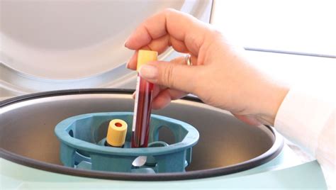 Un análisis de sangre consigue detectar tipos de cáncer con gran precisión CONSTANTES Y VITALES