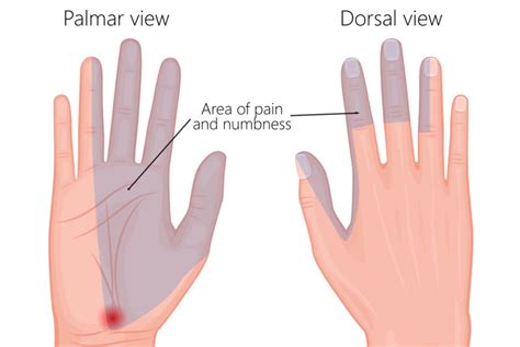 Carpal Tunnel Syndrome Complete Physio