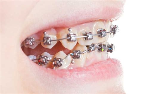 The End Of Self Ligation Or Is It Kevin Obriens Orthodontic Blog