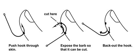 How To Remove A Fish Hook From Your Hand Finger Etc