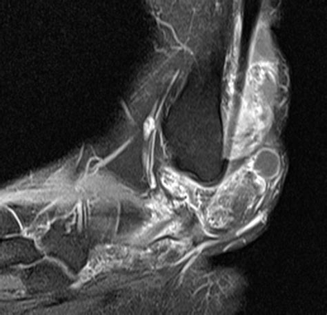 Diffuse Synovial Lipoma Pacs