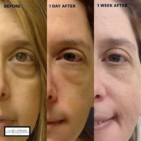 Before After Agnes For Eye Bags Artofit