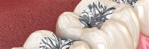 Amalgam Filling Galata Poliklinik