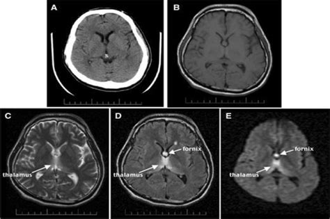 Ct And Mr Scans Of A 35 Year Old Man Diagnosed With Severe
