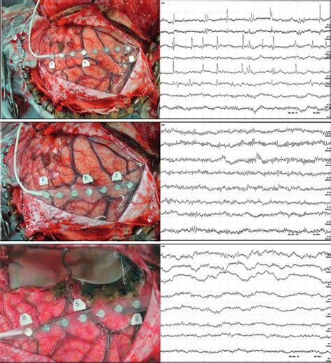 Case 3 Intraoperative Ecog Before Lesion Resection Showing Interictal