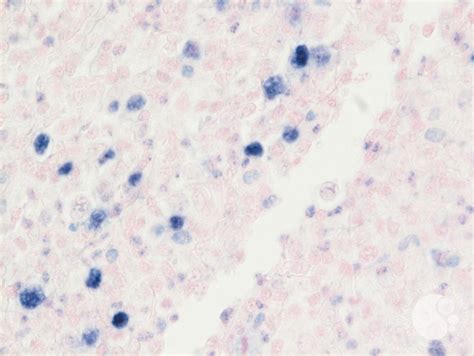 Ebv Reactivation Eber