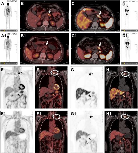 Neuroendocrine Neoplasms Pet Clinics